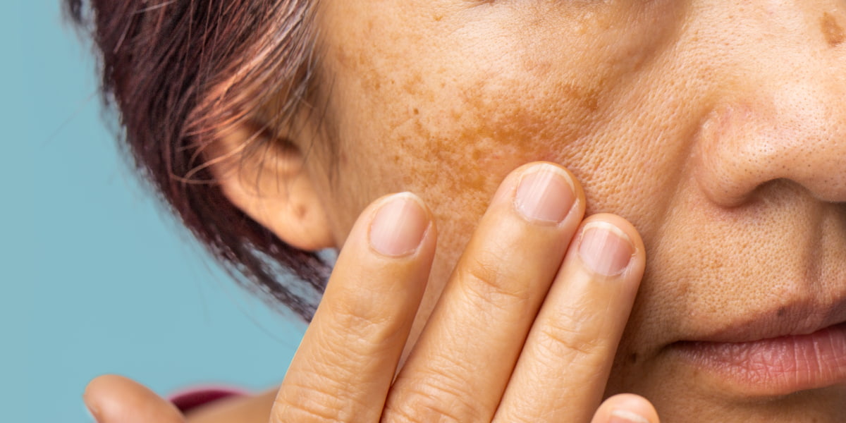 Makeup For Hyperpigmentation In 7 Easy-to-follow Steps