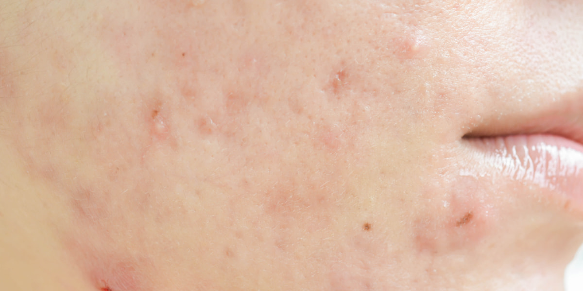 Acne Scars: How To Get Rid Of (All Possible Ways)