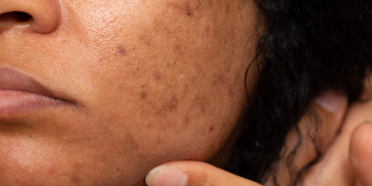 Makeup For Hyperpigmentation In 7 Easy-to-follow Steps