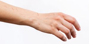 Waking Up With Scratches: Reasons And How To Prevent It