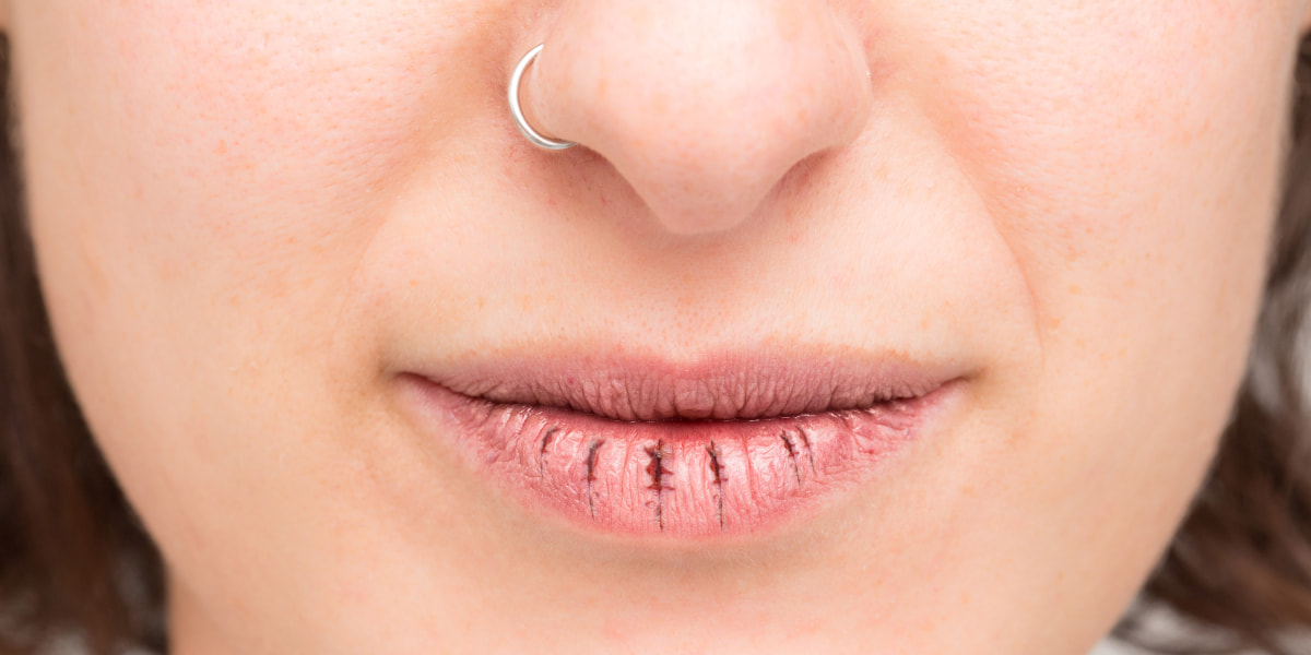 Best Remedies For Chapped Lips: Top 16 Solutions