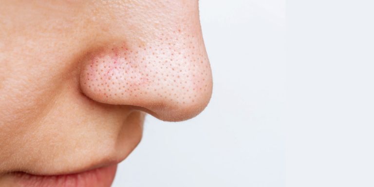 How To Clean Your Nose Pores And Prevent Their Appearing?