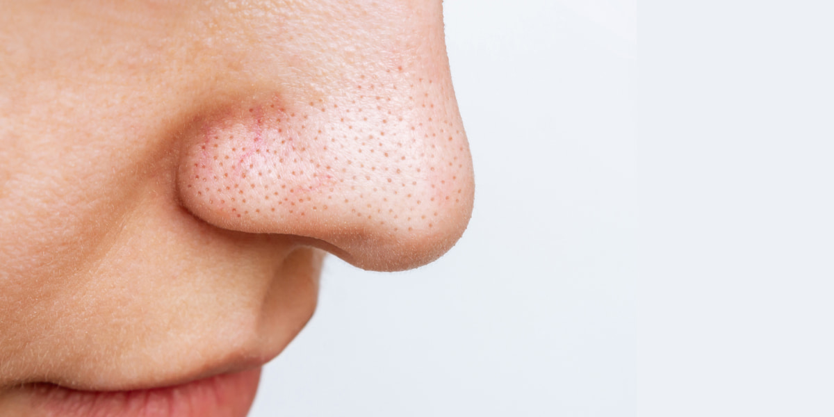 How To Clean Your Nose Pores And Prevent Their Appearing?