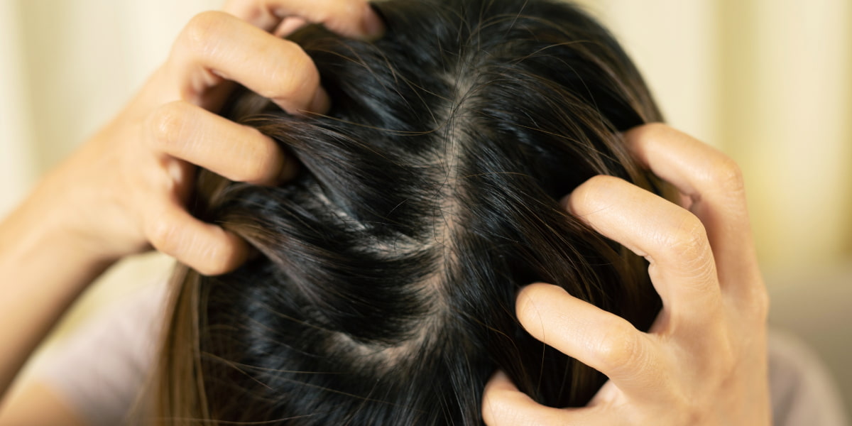 What Is Receding Hairline And How To Prevent It