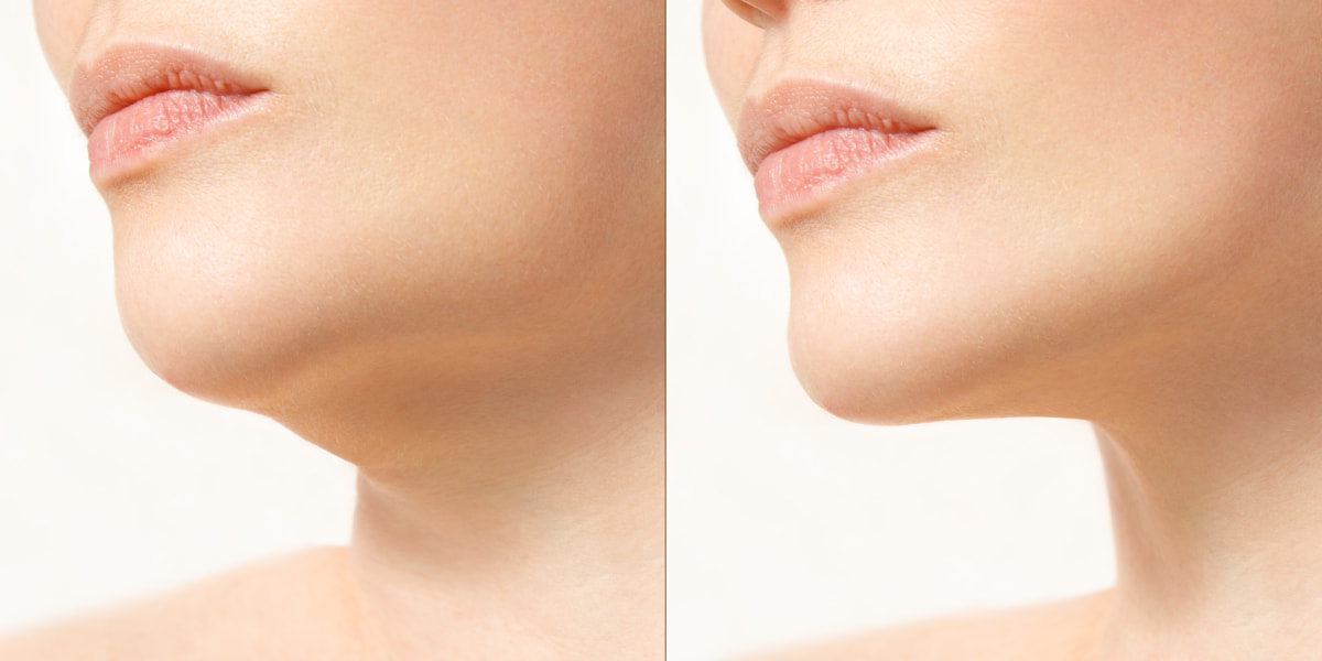 How To Remove Double Chin? Double Chin Causes And Treatment