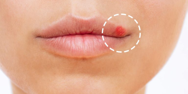 How To Get Rid Of Lip Pimple: Useful Tips