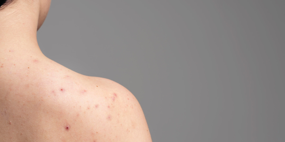 How To Get Rid Of Back Acne At Home Once And For All?
