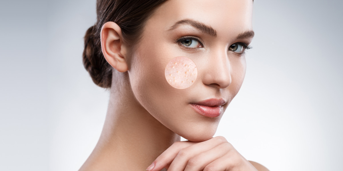 How To Extract Milia: Our 6 Proven Methods