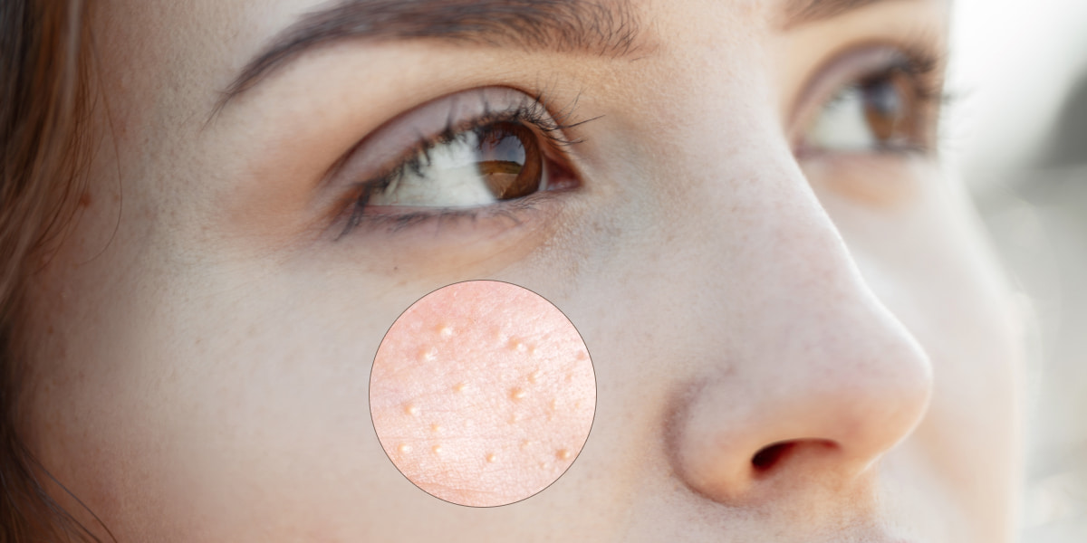 How To Extract Milia: Our 6 Proven Methods