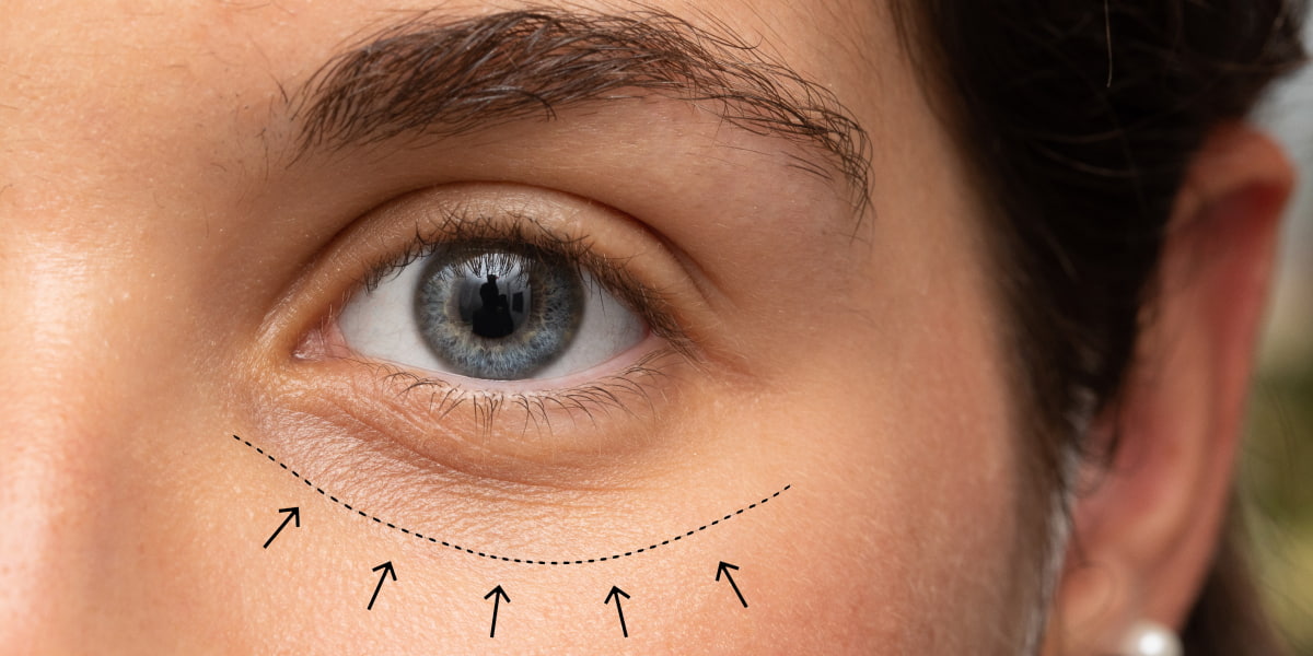 Under-Eyes Filler: What Should You Know