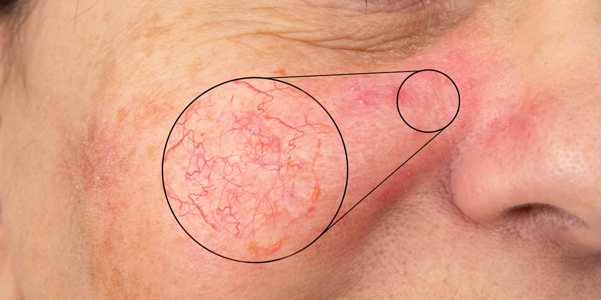 Best Ways To Get Rid Of Broken Blood Vessels On The Face