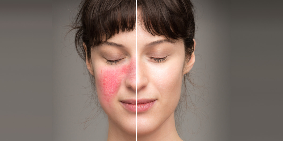 Best Ways To Get Rid Of Broken Blood Vessels On The Face