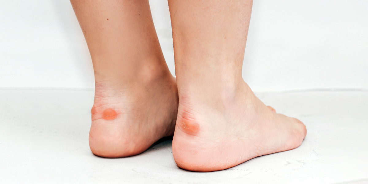 How to Get Rid of Calluses on Feet: 7 Methods