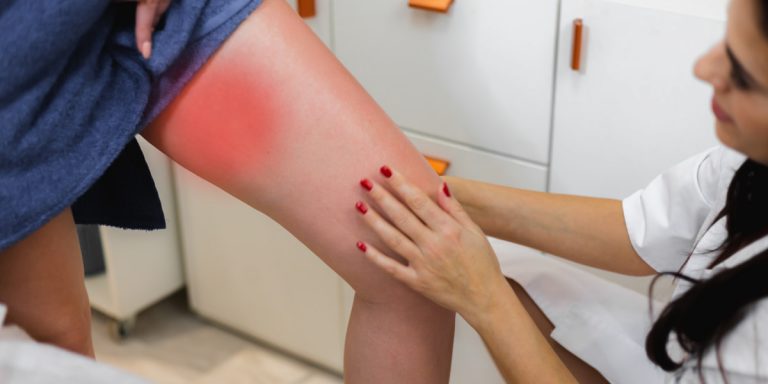 Inner Thigh Chafing Causes Symptoms And Treatment